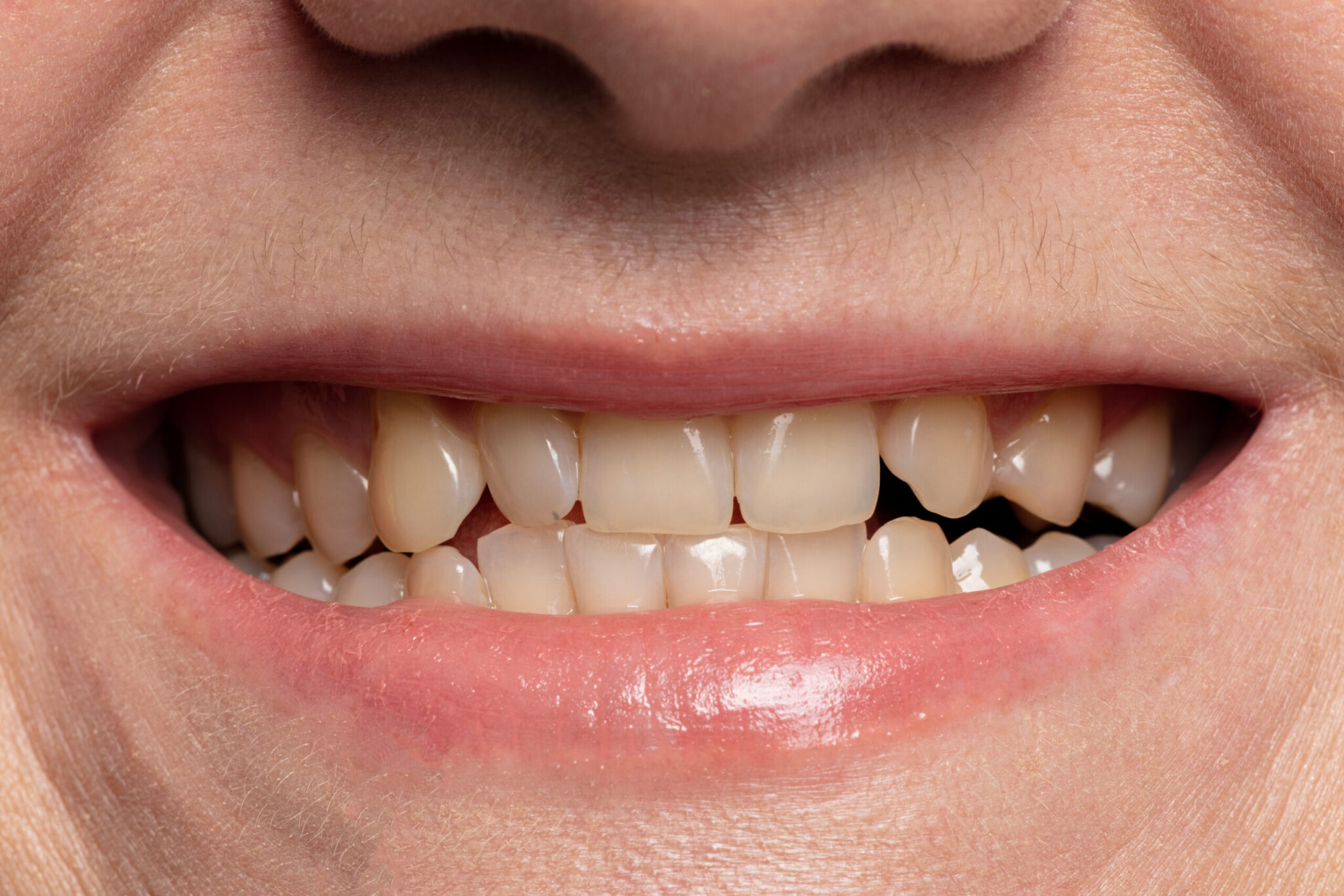 Debunking Myths About Veneers: Do They Damage Teeth?