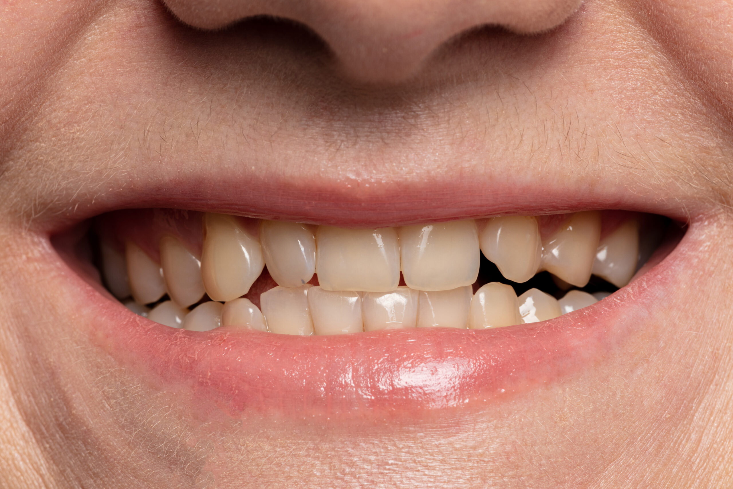 Debunking Myths About Veneers: Do They Damage Teeth?