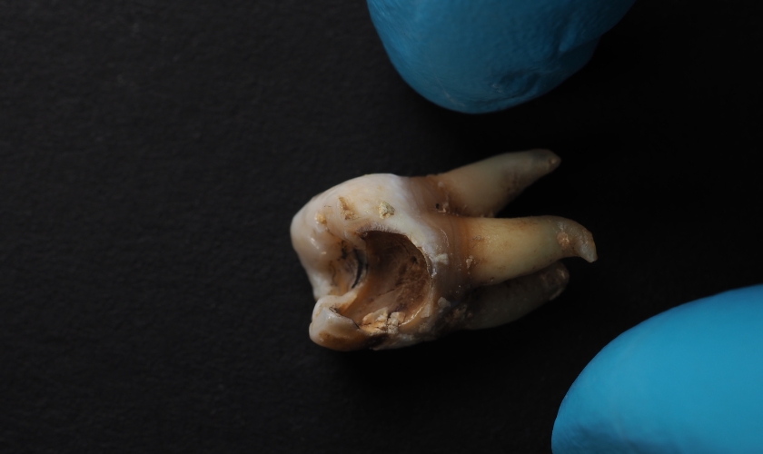 Best Methods for Cavities Treatment