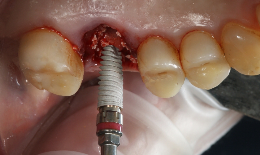 Dental Implants & Gums: The Healing & Bonding Process