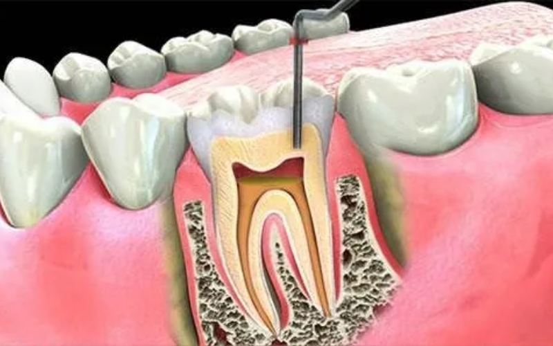 Pull Molar or Root Canal Therapy: Make the Right Choice